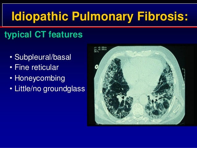 Ipf or non ipf interstitial lung diseases