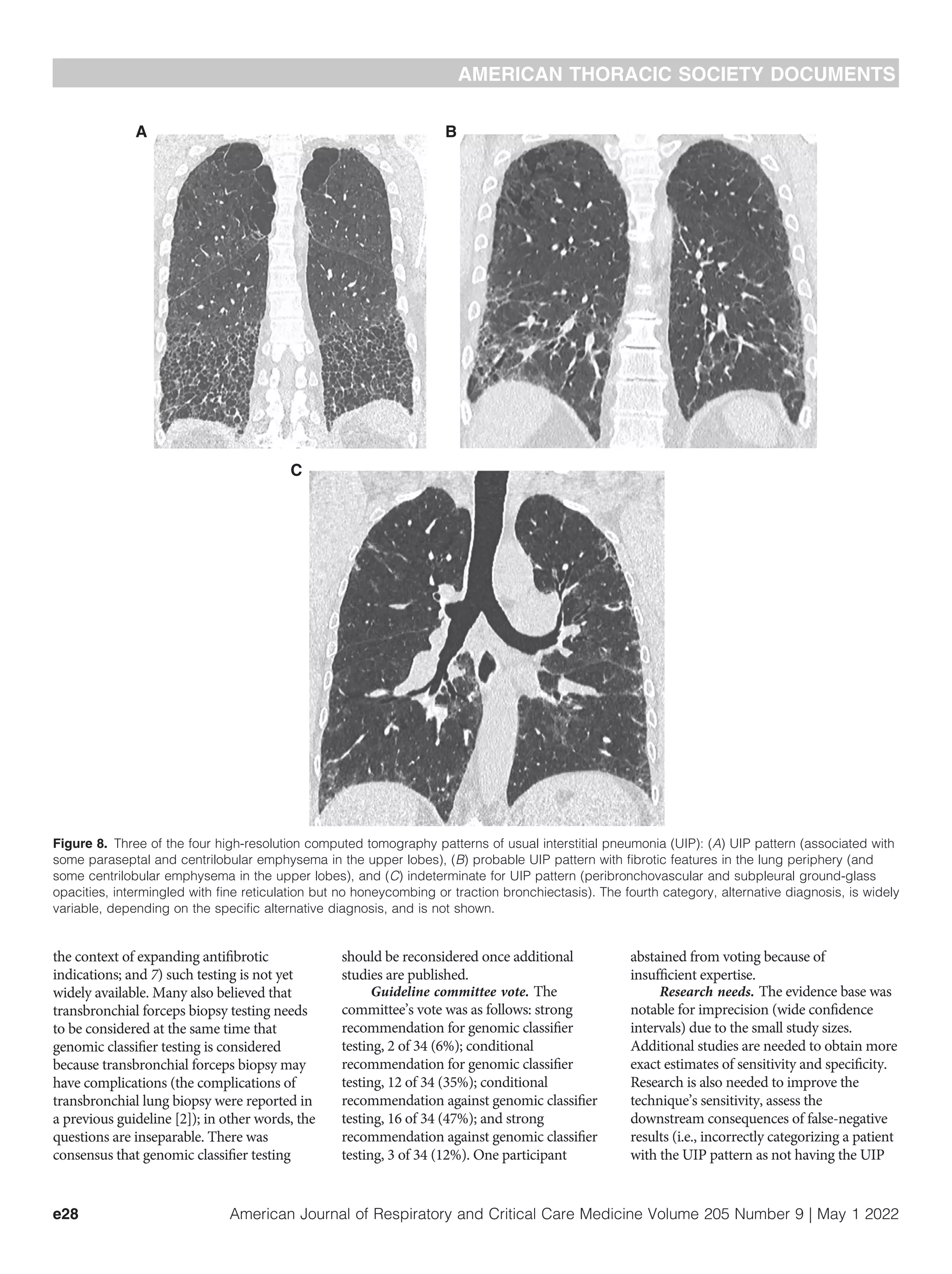IPF & Progressive Pulmonary Fibrosis in Adult ATS ERS JRS Clinical ...