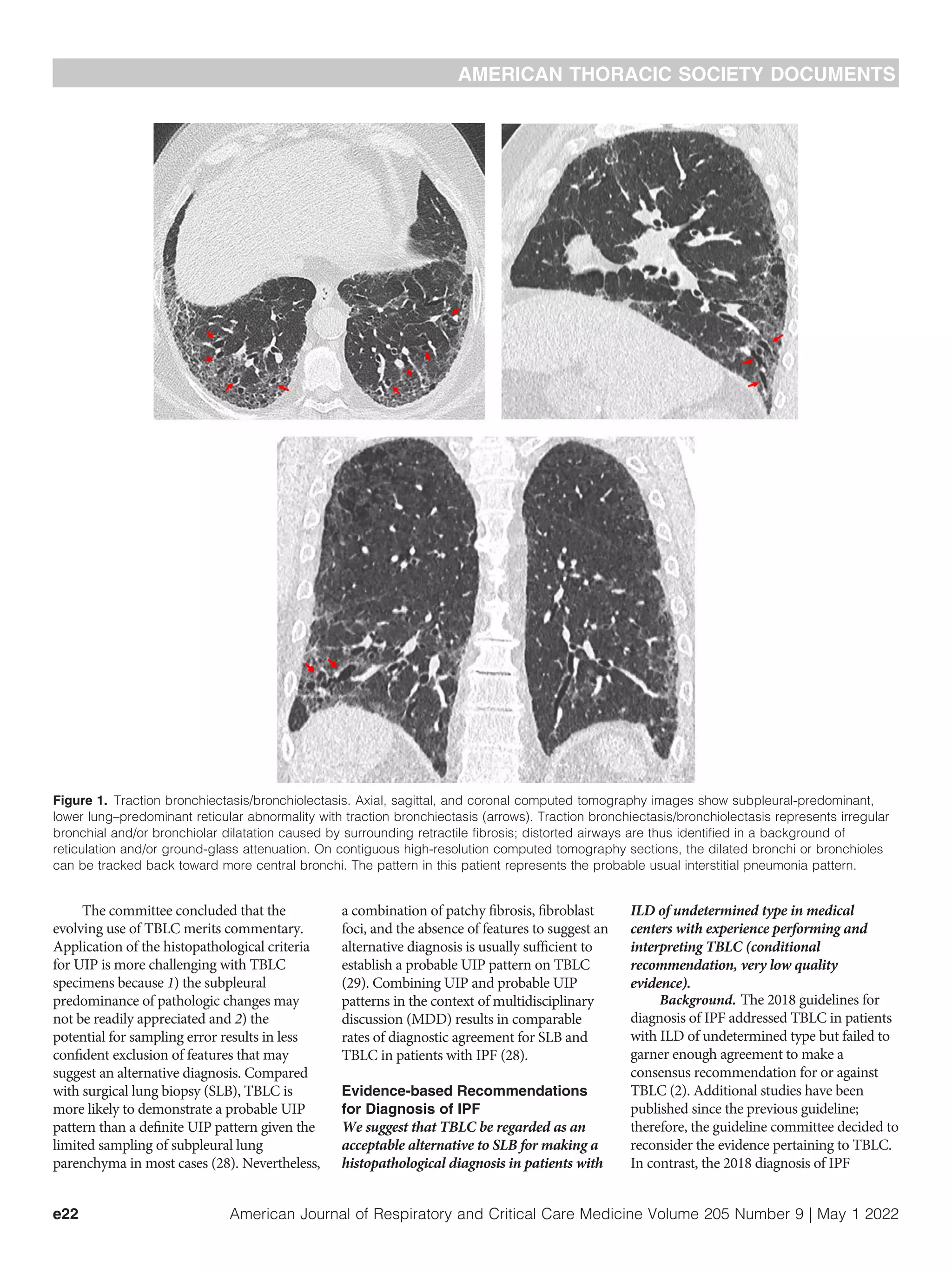 IPF & Progressive Pulmonary Fibrosis in Adult ATS ERS JRS Clinical ...