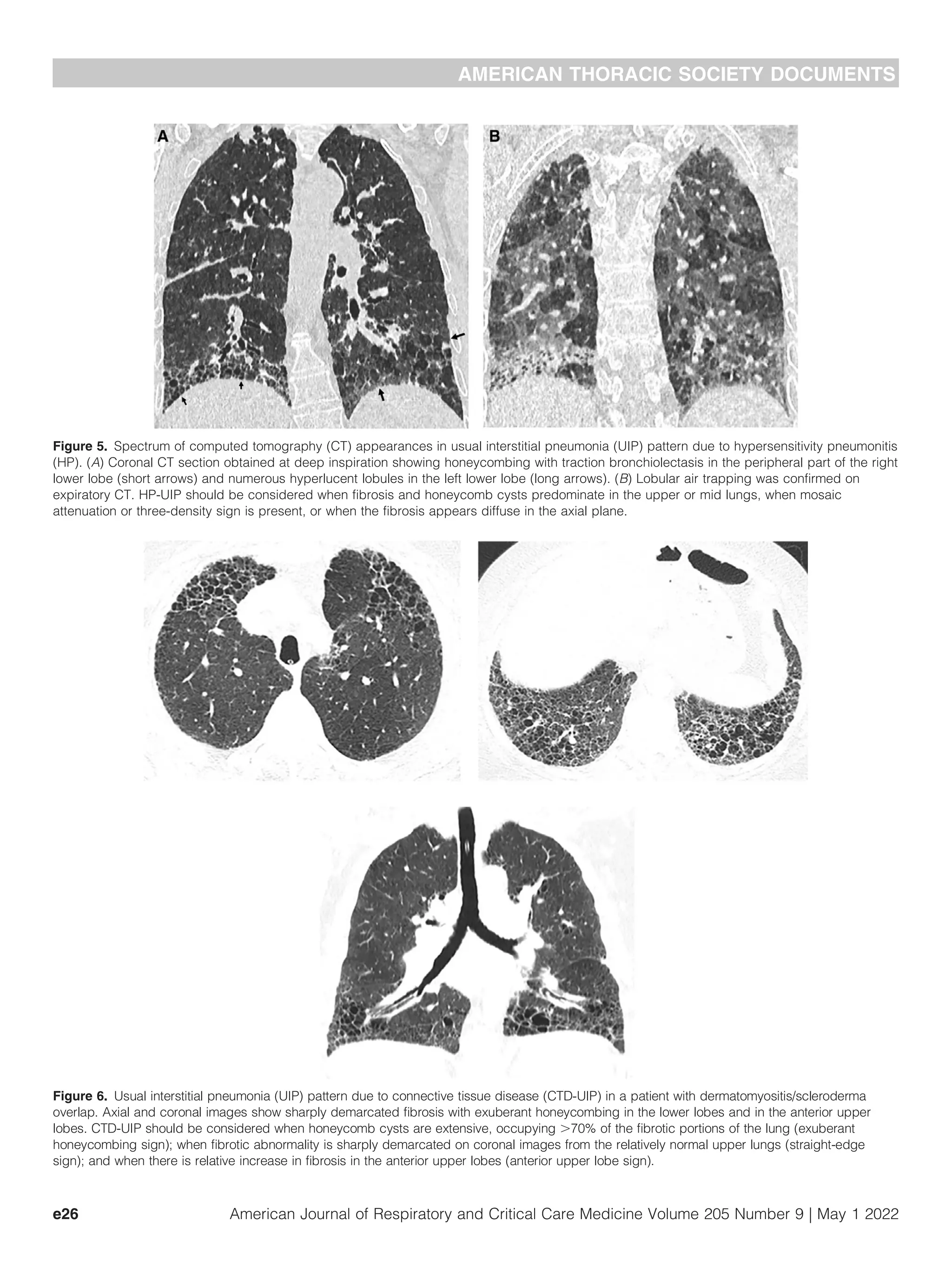 IPF & Progressive Pulmonary Fibrosis in Adult ATS ERS JRS Clinical ...
