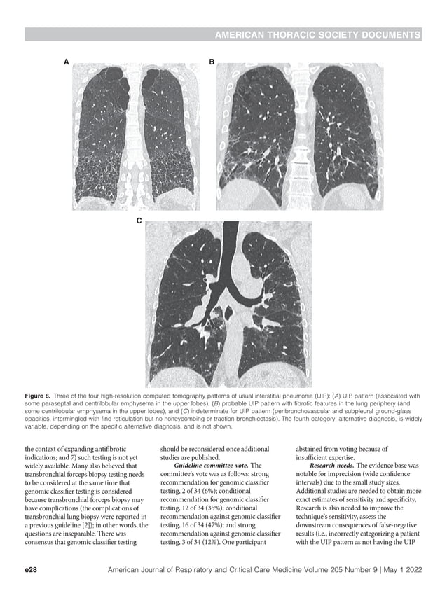 IPF & Progressive Pulmonary Fibrosis in Adult ATS ERS JRS Clinical ...