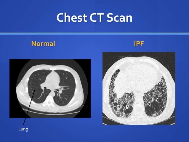 IPF Webinar for the British Lung Foundation 2012: Dr Helen Parfrey