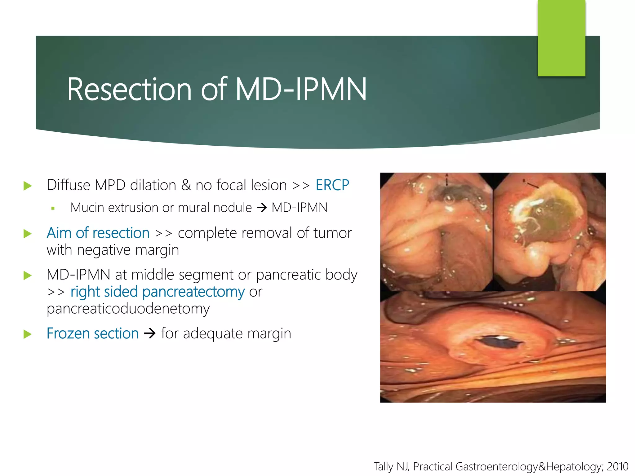 Management of IPMN | PPTX