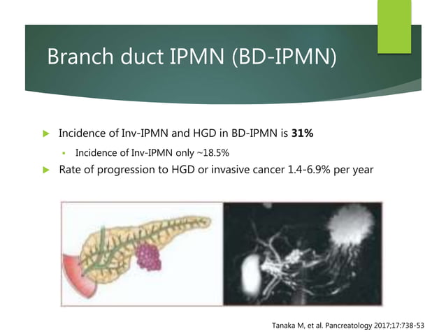Management of IPMN | PPTX
