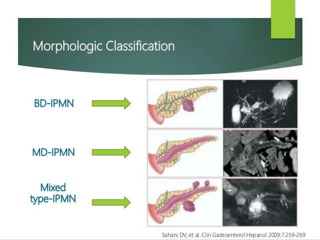 Management of IPMN