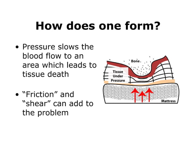 How to Identify and Prevent Pressure Ulcers | PPT