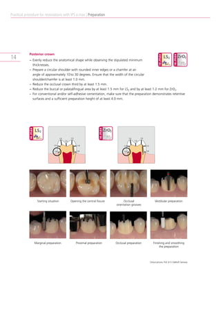 Ips+e max+clinical+guide | PDF