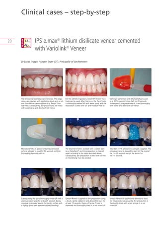 Ips+e max+clinical+guide | PDF
