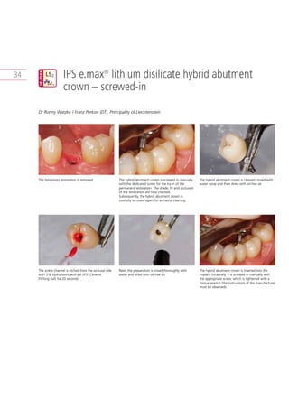 Ips+e max+clinical+guide | PDF