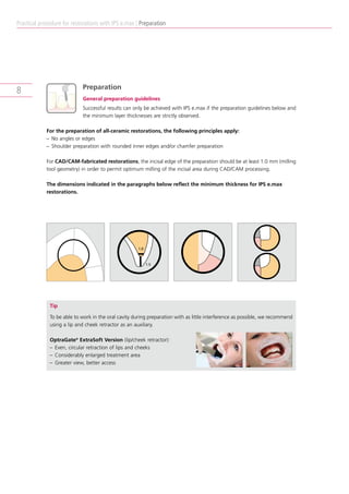 Ips+e max+clinical+guide | PDF