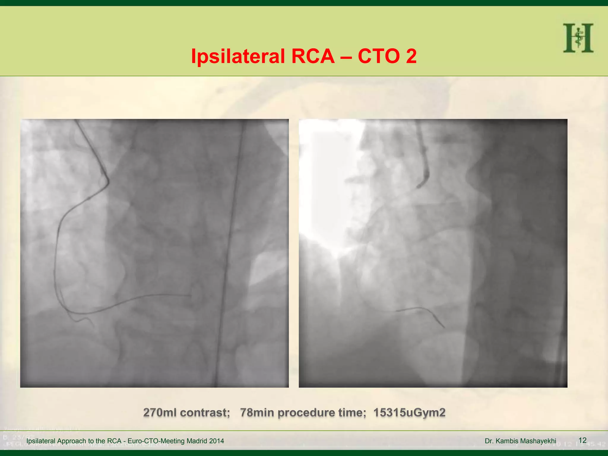 14:25 Mashayekhi - Ipsilateral approach | PPT