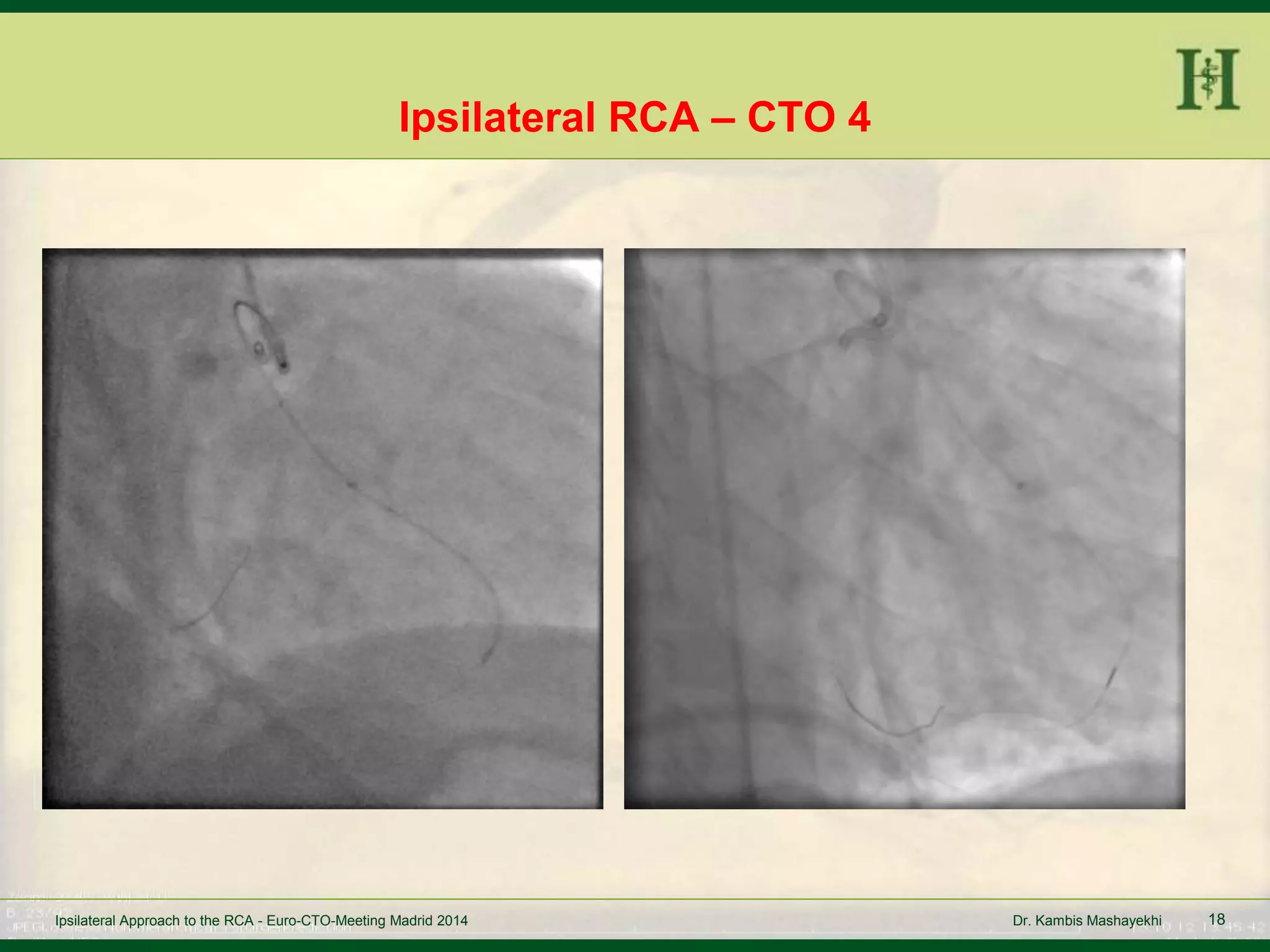 14:25 Mashayekhi - Ipsilateral approach | PPT