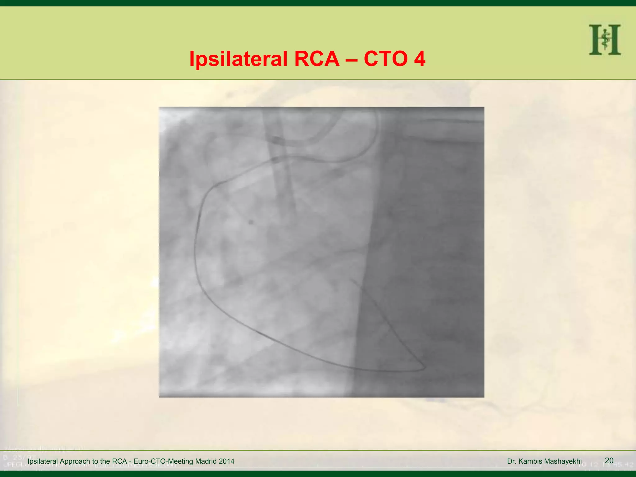 14:25 Mashayekhi - Ipsilateral approach | PPT