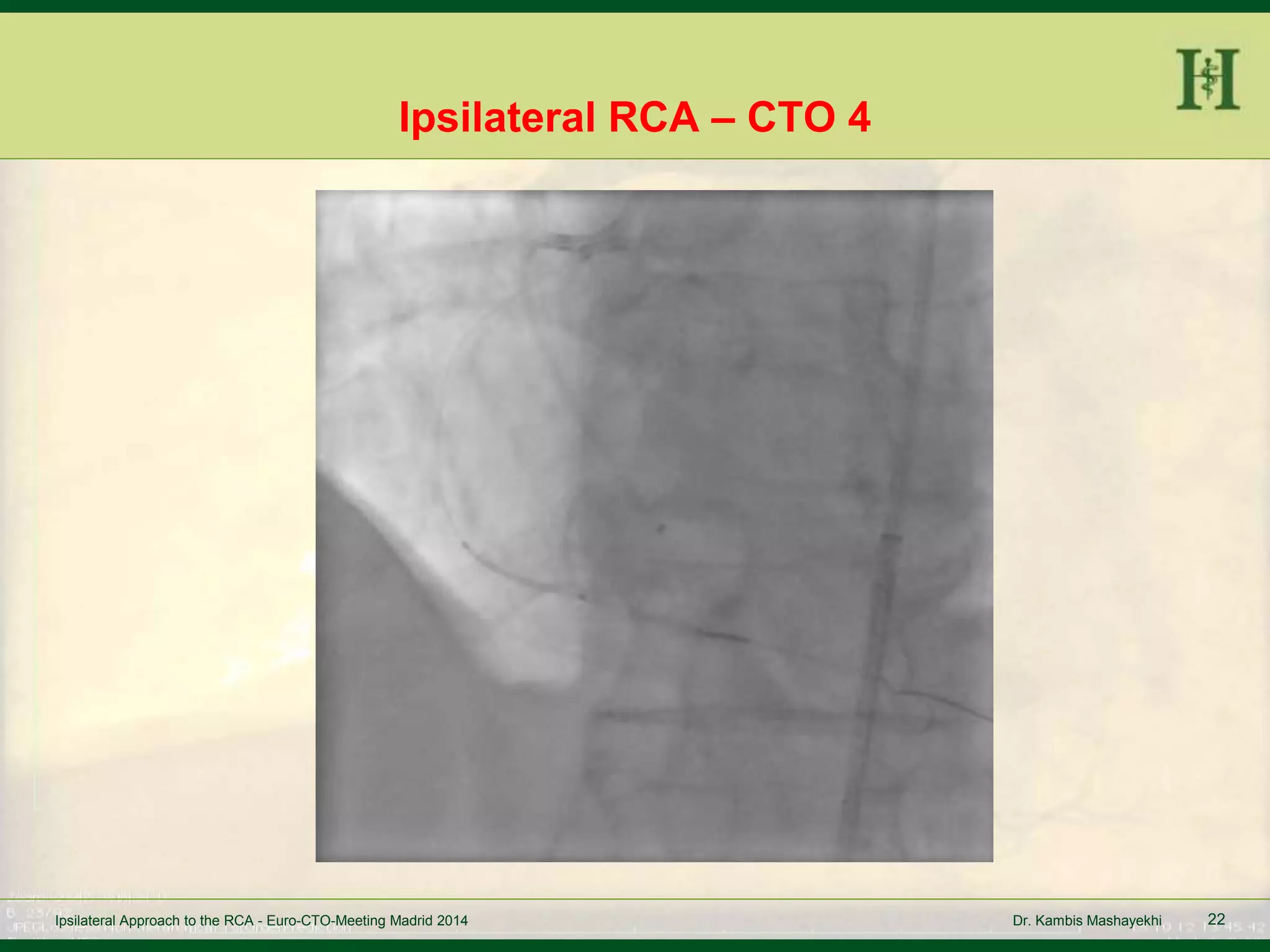 14:25 Mashayekhi - Ipsilateral approach | PPT
