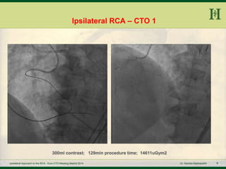 14:25 Mashayekhi - Ipsilateral approach | PPT