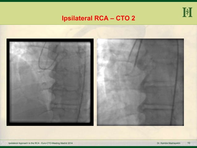 14:25 Mashayekhi - Ipsilateral approach | PPT