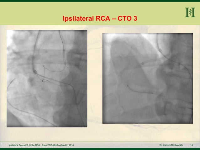 14:25 Mashayekhi - Ipsilateral approach | PPT