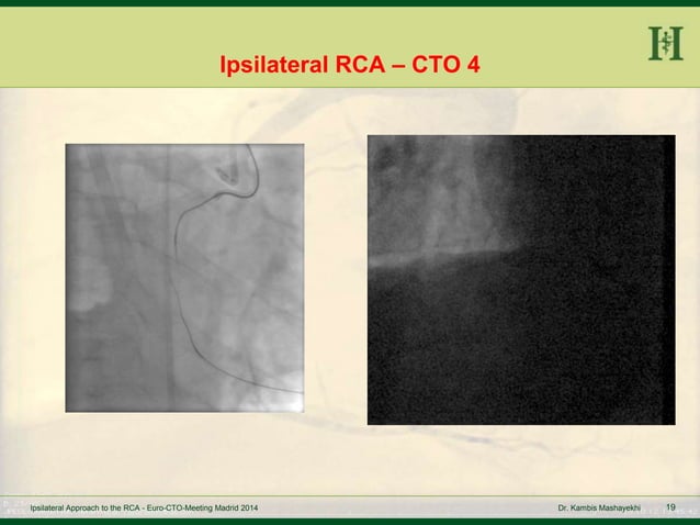 14:25 Mashayekhi - Ipsilateral approach | PPT