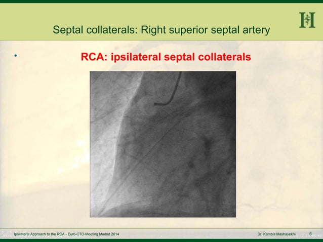 14:25 Mashayekhi - Ipsilateral approach | PPT