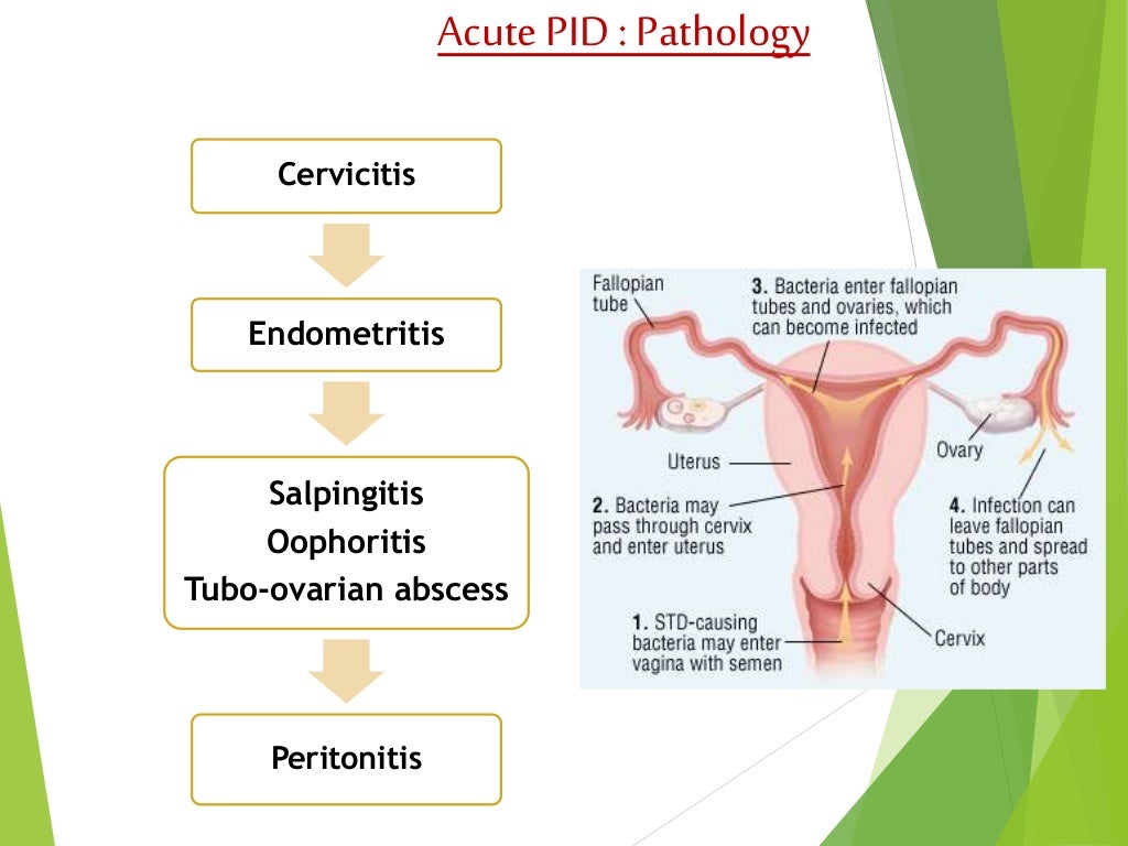 Pelvic inflammatory disease (pid)