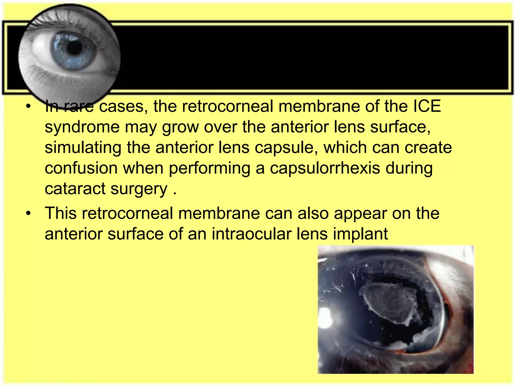 Iridocorneal endothelial syndrome | PPTX