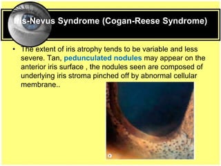 Iridocorneal endothelial syndrome | PPTX | Eye and Vision Conditions ...