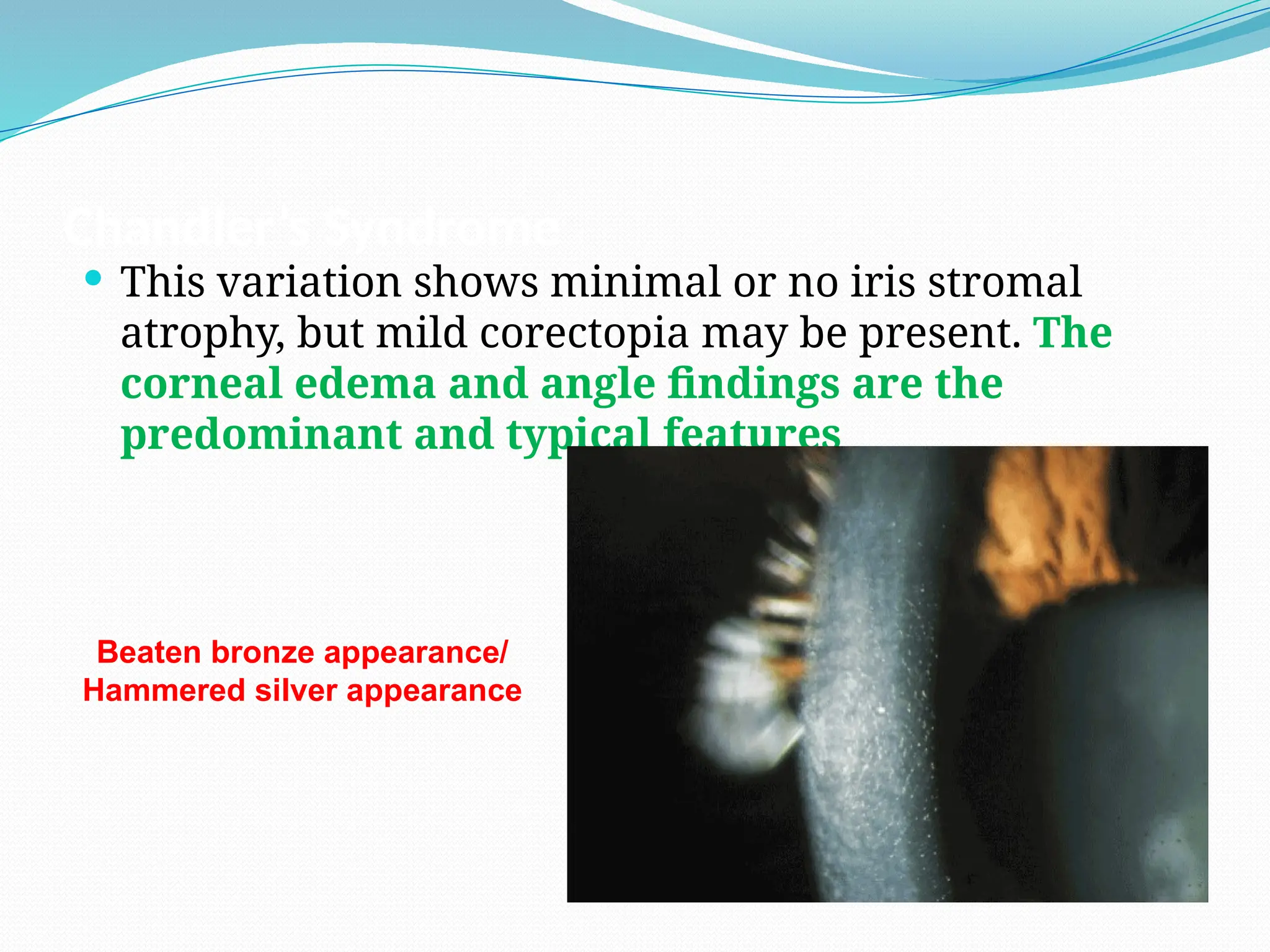 iridocornealendothelialsyndrome-160426130917 (2).pptx