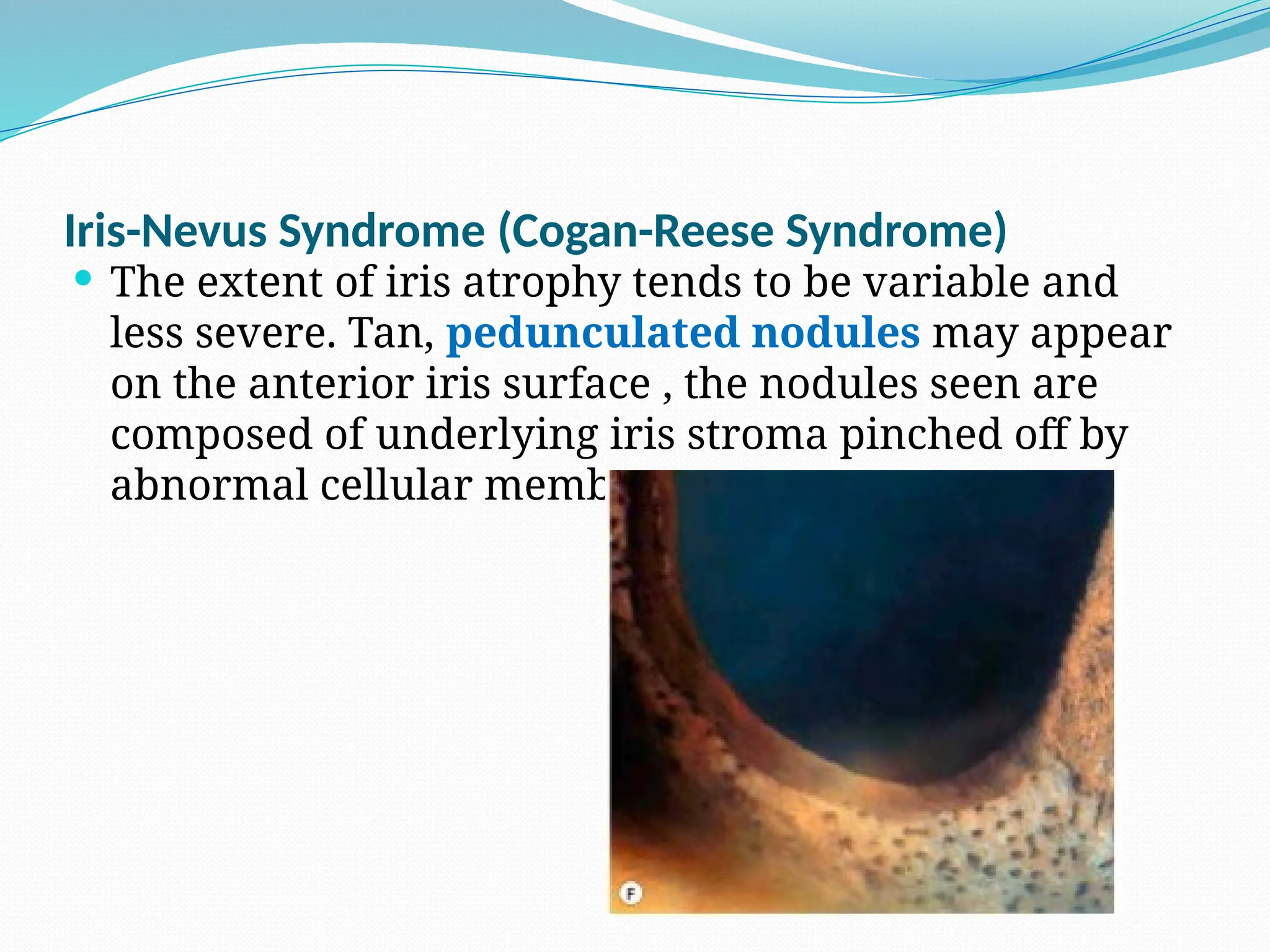 iridocornealendothelialsyndrome-160426130917 (2).pptx