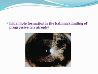 iridocornealendothelialsyndrome-160426130917 (2).pptx
