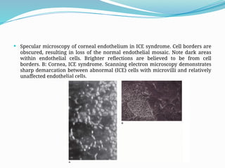 iridocornealendothelialsyndrome-160426130917 (2).pptx