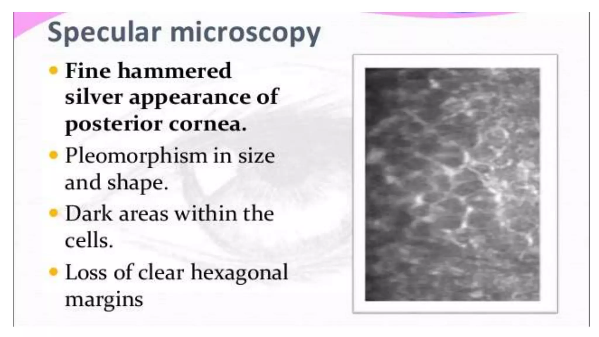 Iridocorneal endothelial syndrome | PPTX