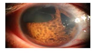 Iridocorneal endothelial syndrome | PPTX