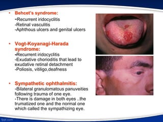 Iridocyclitis | PPT
