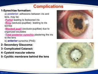 Iridocyclitis | PPT