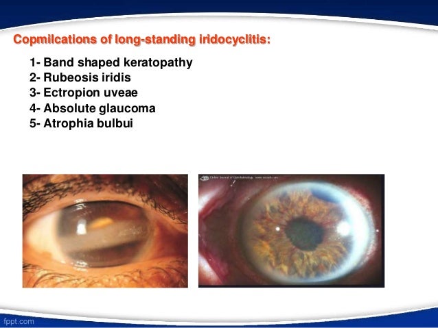 Iridocyclitis