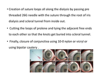 Iridodialysis repair | PPTX