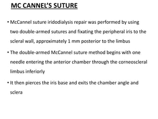 Iridodialysis repair | PPTX