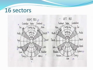 IRIS CHART.pptx iris chart of eyes in human | PPTX | Eye and Vision ...