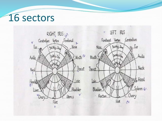 IRIS CHART.pptx iris chart of eyes in human | PPTX | Eye and Vision ...
