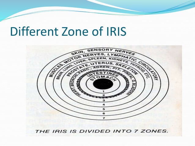 IRIS CHART.pptx iris chart of eyes in human | PPTX | Eye and Vision Conditions | Diseases and ...