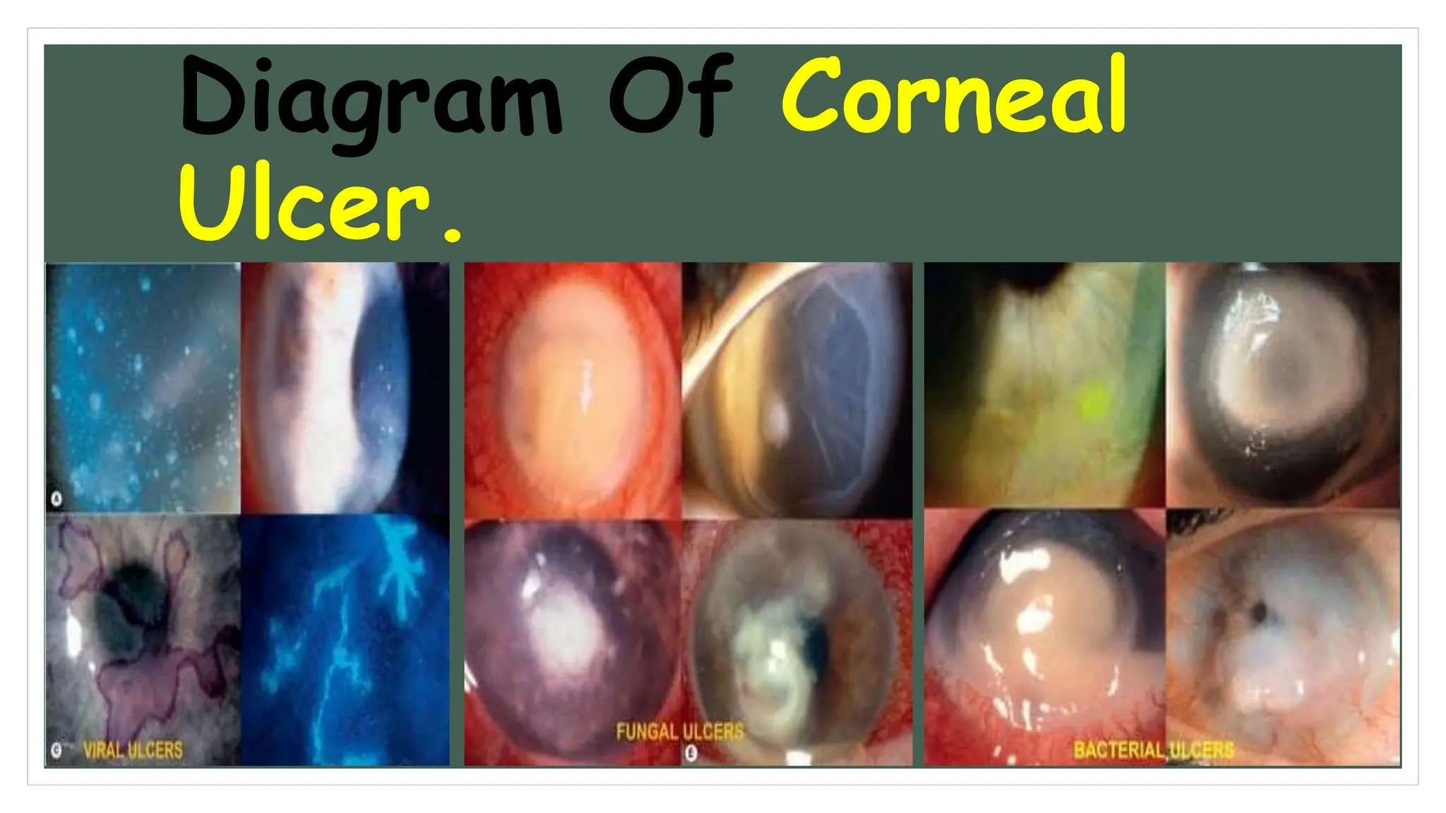 Iritis and Corneal Ulcer Presentation.pptx