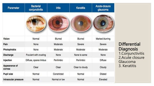 Iritis and Corneal Ulcer Presentation.pptx