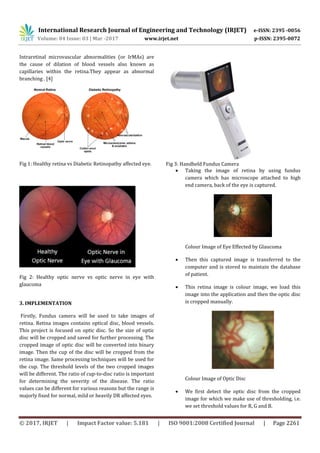Optical Disc Detection, Localization and Glaucoma Identification of ...