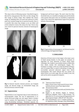 Pre-treatment and Segmentation of Digital Mammogram | PDF