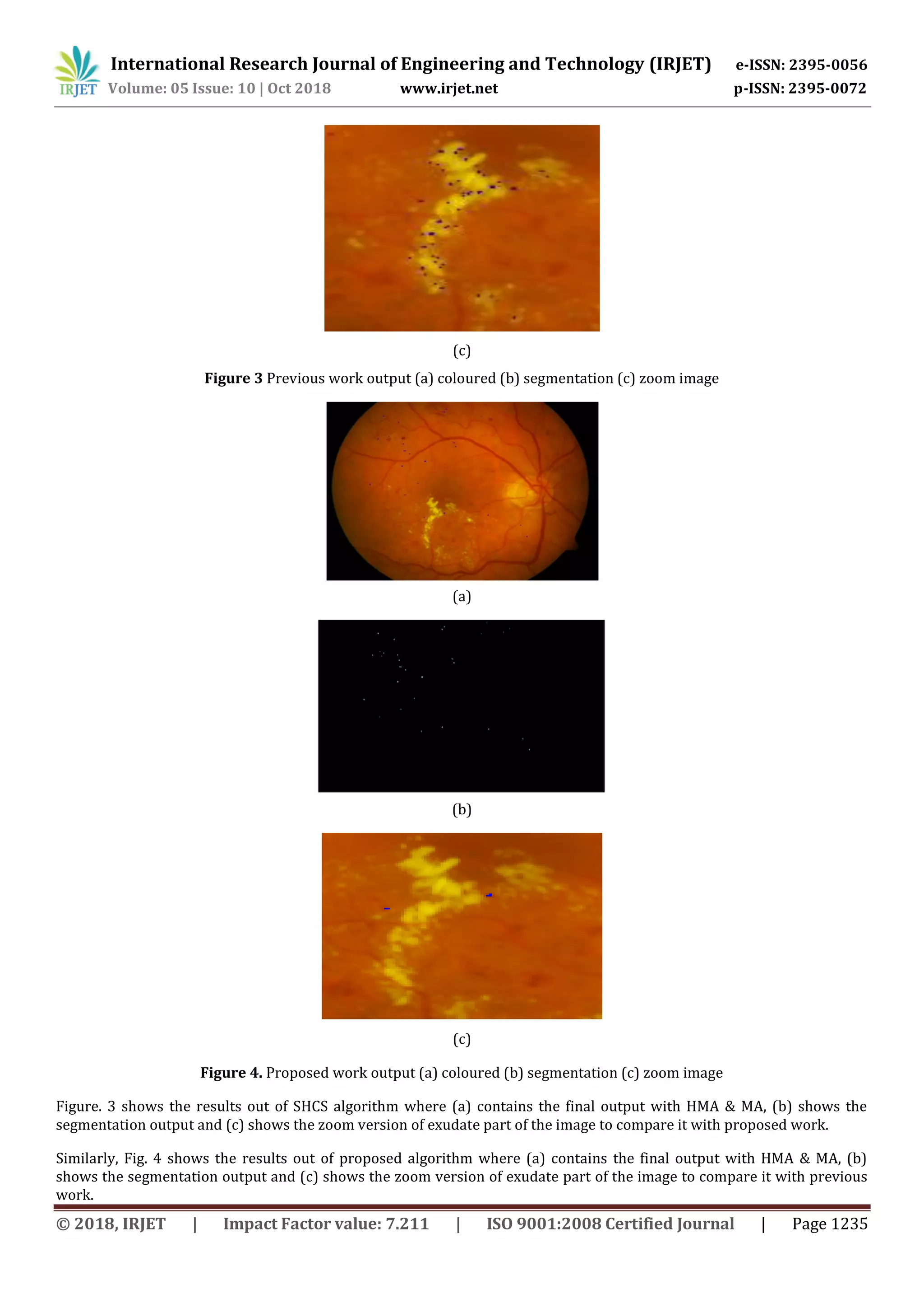 Irjet Application Of False Removal Algorithm Specially For Retinal Images With Exudates In