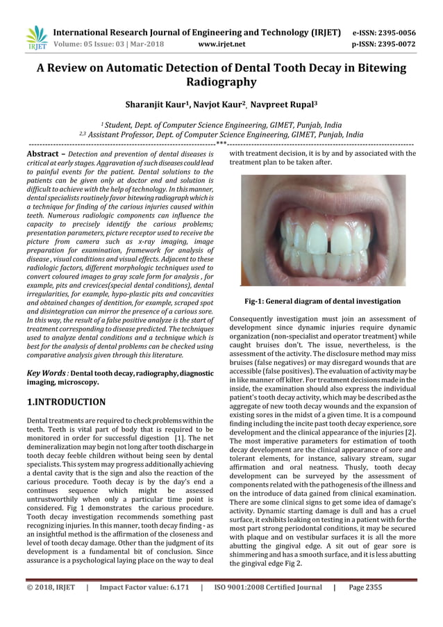 IRJET- A Review on Automatic Detection of Dental Tooth Decay in ...