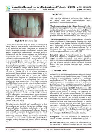 IRJET- A Review on Automatic Detection of Dental Tooth Decay in ...