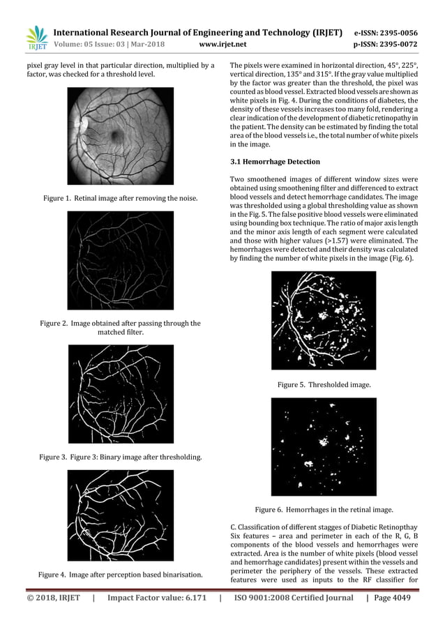 IRJET- Characterization of Diabetic Retinopathy Detection of Exudates ...