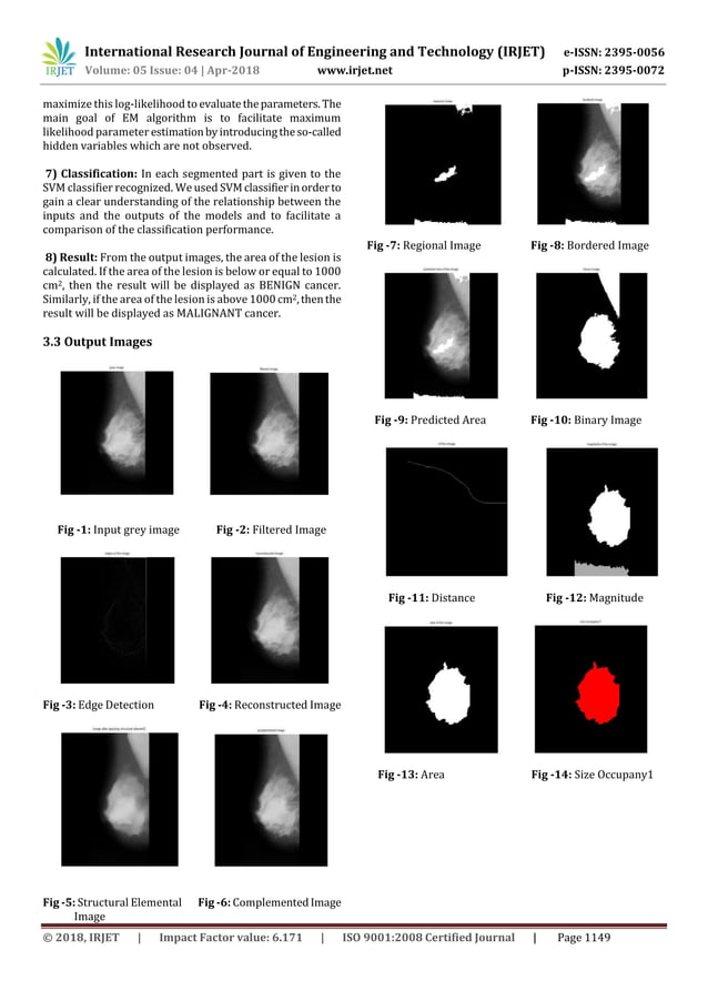 IRJET- Detection of Suspicious Lesions in Mammogram using Zebra Medical Vision Algorithm | PDF ...
