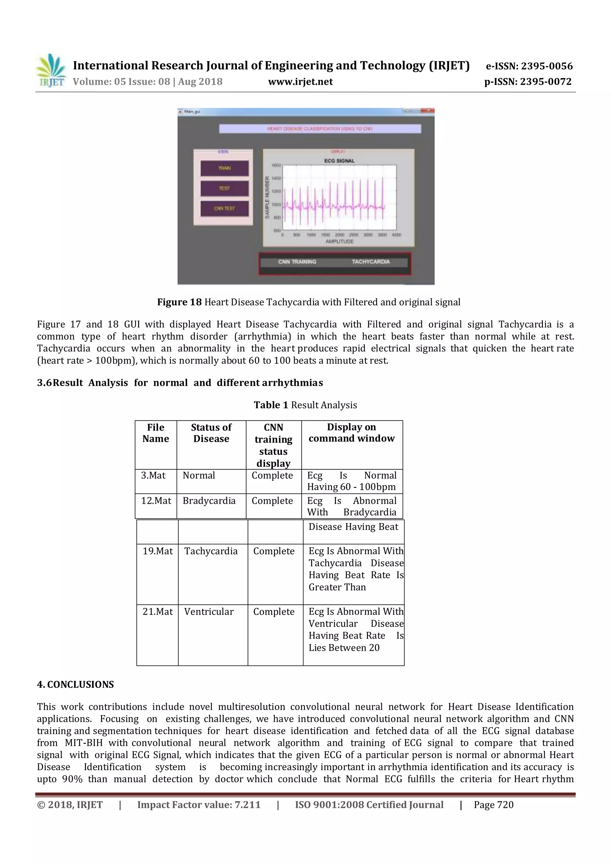Irjet Arrhythmia Detection Using One Dimensional Convolutional Neural